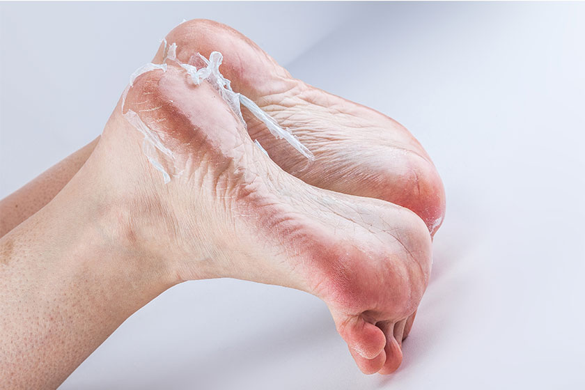 Five Foot Problems That Often Come With Age | Discovery Commons by ...