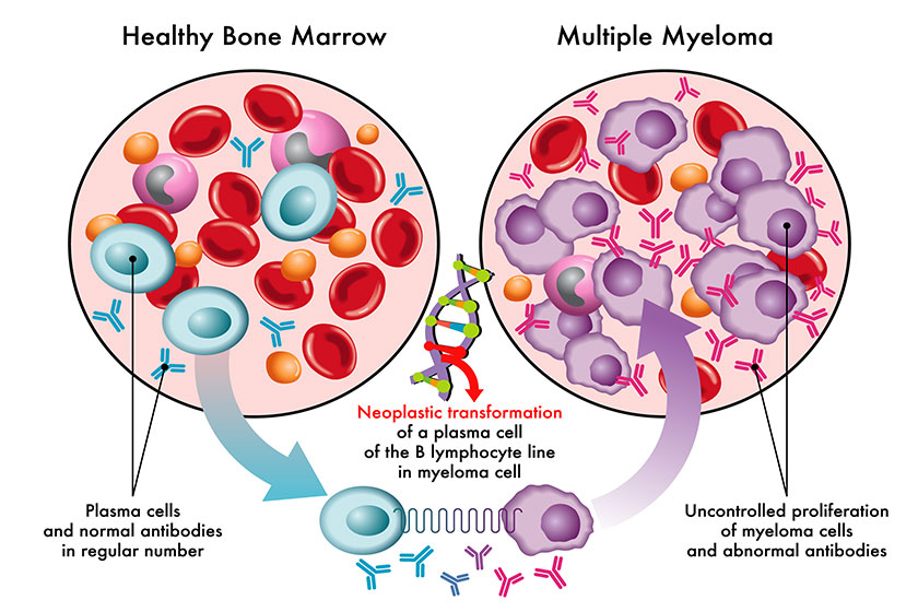 Unveiling The Early Signs Of Myeloma In Seniors | Discovery Commons by ...